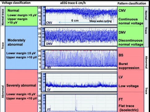 aEEG trace