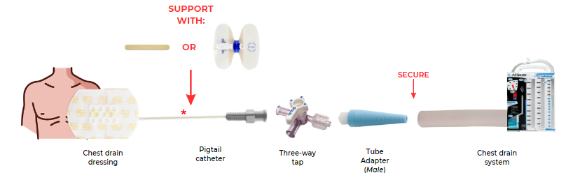 pigtail chest tube