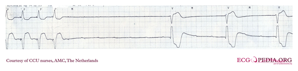 Pacemakers (temporary) for a child