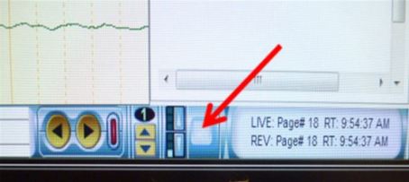 Brain monitoring in the neonate - Video aEEG