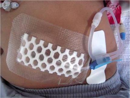 Peritoneal dialysis procedure guideline