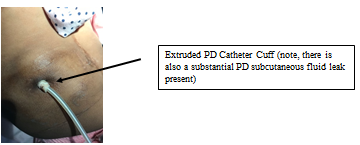Extruded catheter cuff