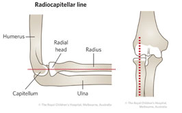 Fracture - monteggia fracture dislocations