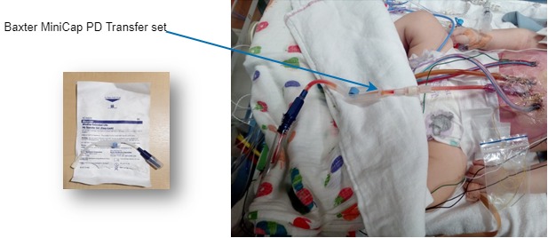 Peritoneal Dialysis in the Cardiac Patient in PICU