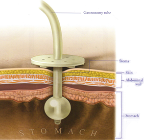 Gastrostomy, transgastric–jejunal, jejunal tube care