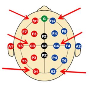 Brain monitoring in the neonate - Video aEEG