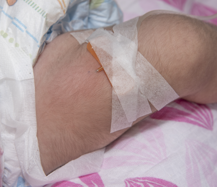 Subcutaneous Immunoglobulin (SCIg) Therapy