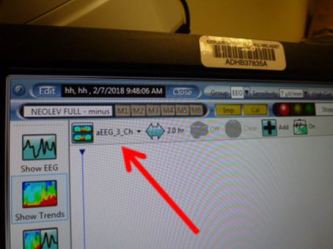 Brain monitoring in the neonate - Video aEEG