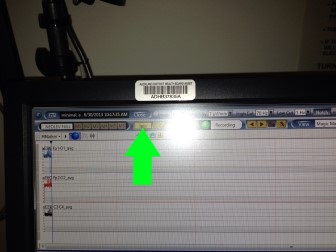 Brain monitoring in the neonate - Video aEEG