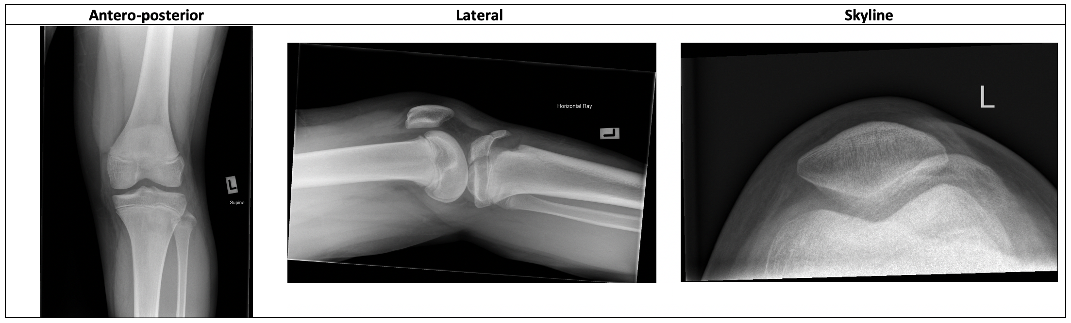 tibial tubercule fracture xray series