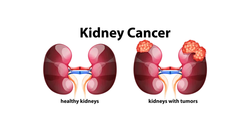 Kidney Cancer: Symptoms, Causes, Types, Stages & Treatment