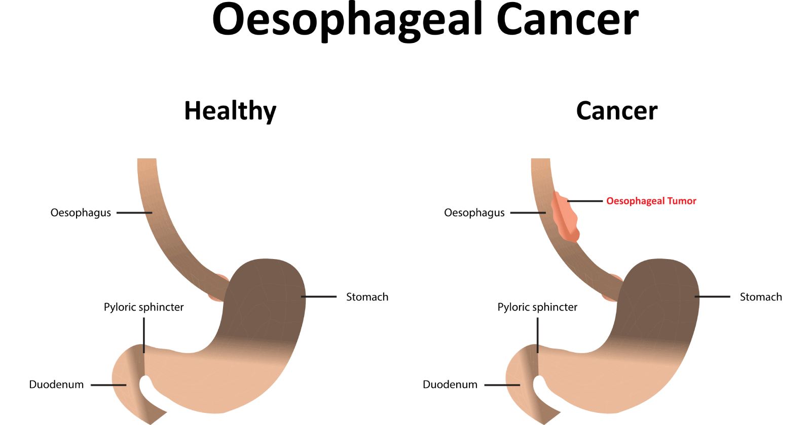 Oesophageal Cancer: Symptoms, Causes, Prevention and Treatments