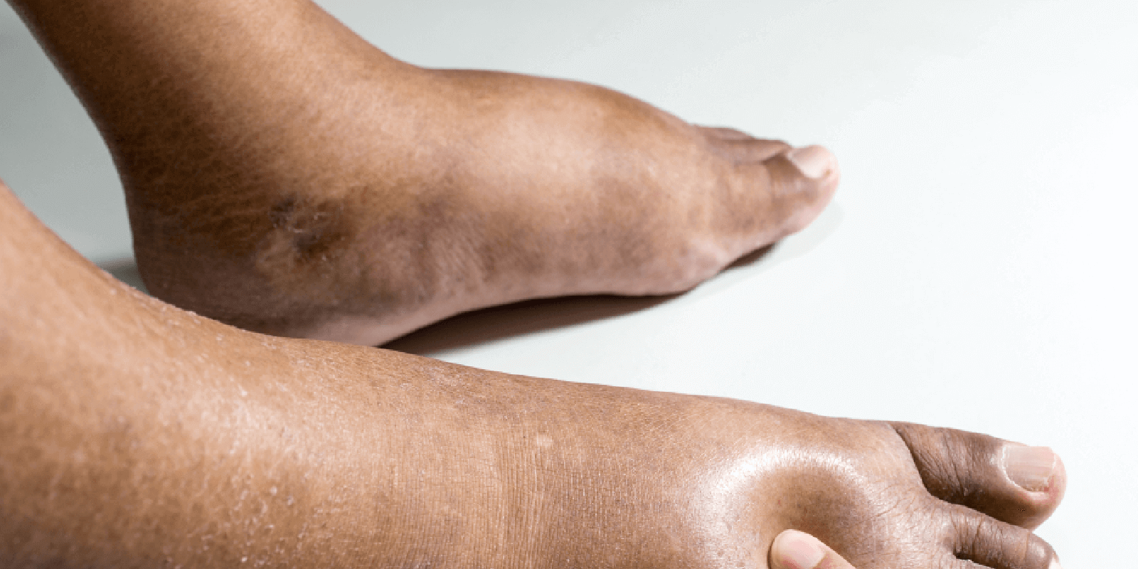 Leg Swelling : Overview, Symptoms, Causes, Diagnosis & Treatments