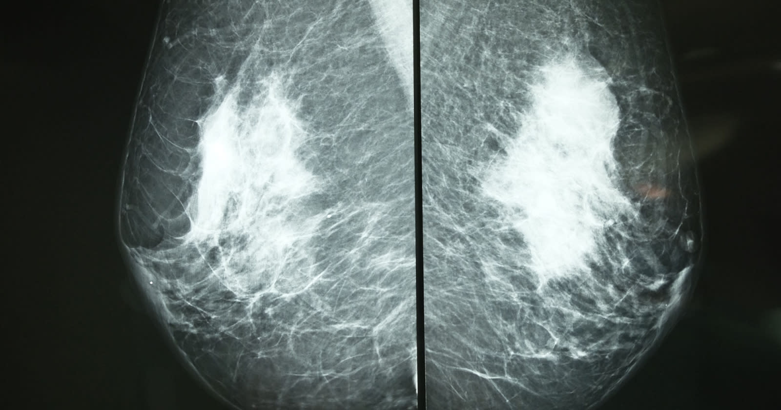 Breast Calcifications: Meaning, Symptoms, Causes & Treatment