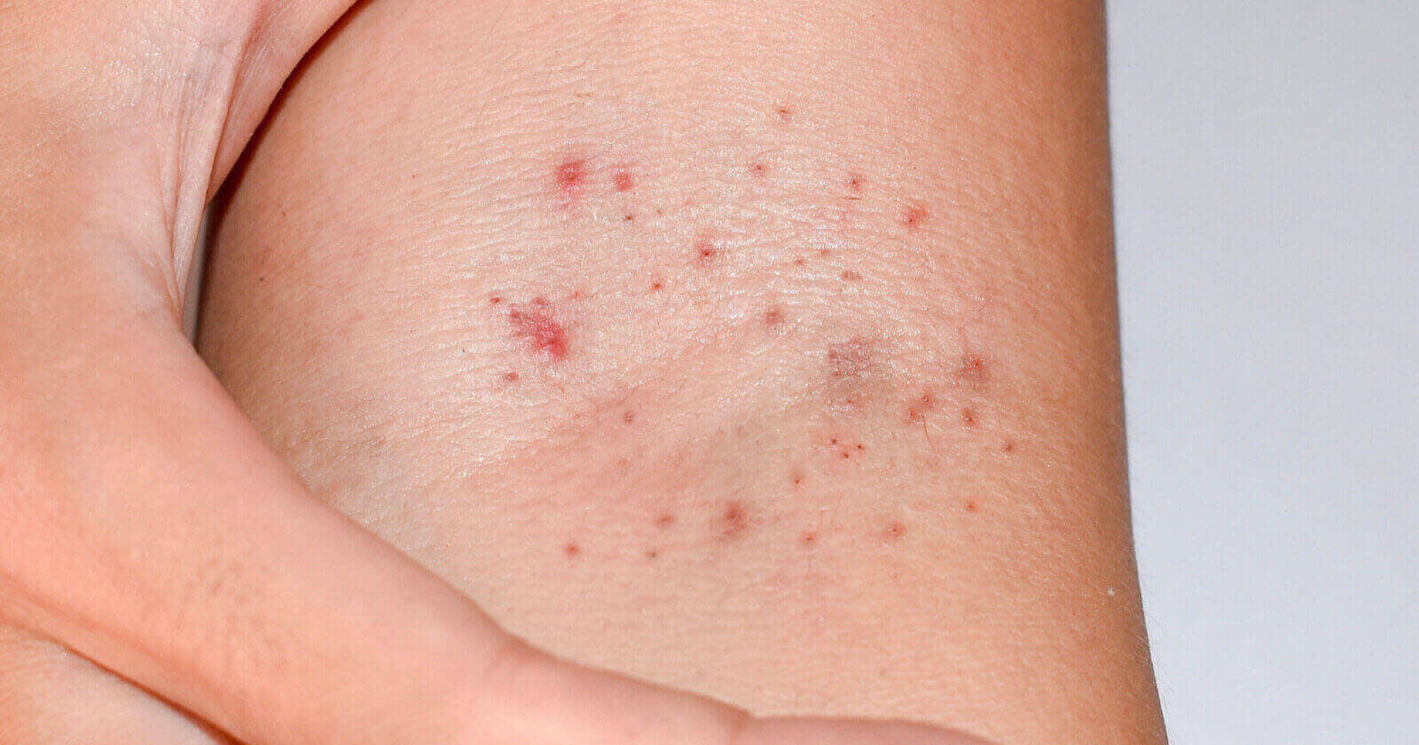 Petechiae: Meaning, Symptoms, Causes & Treatment