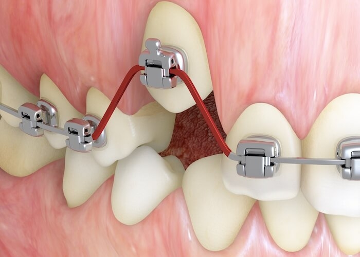 Shape-memory alloys bid adieu to old-school orthodontics