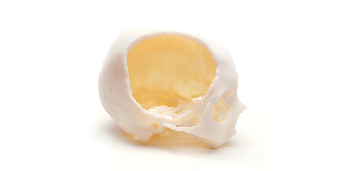 Custom skull implants break the mold for head-trauma treatment