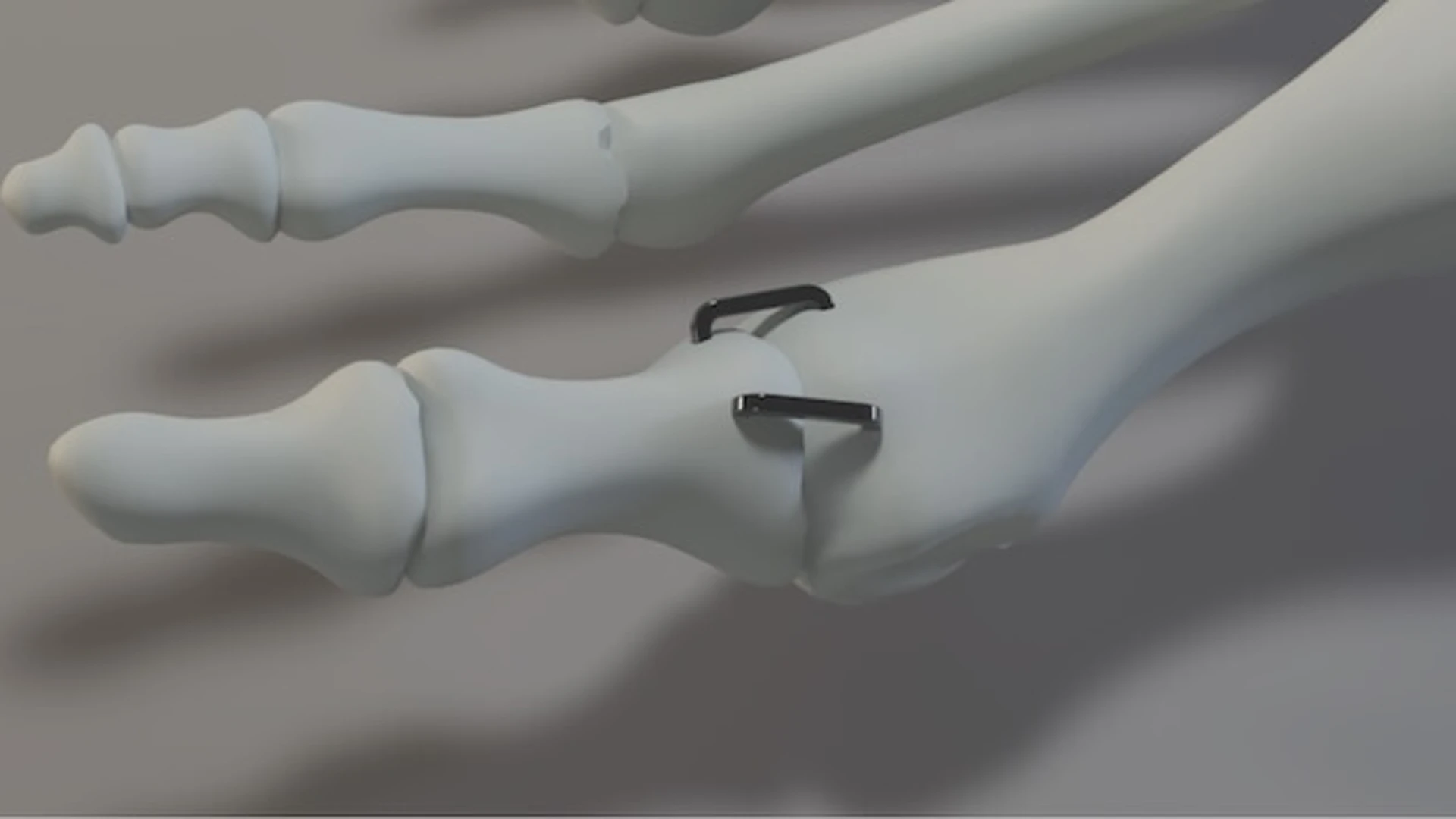 Shape-memory alloys bid adieu to old-school orthodontics Shape-memory alloys bid adieu to old-school orthodontics