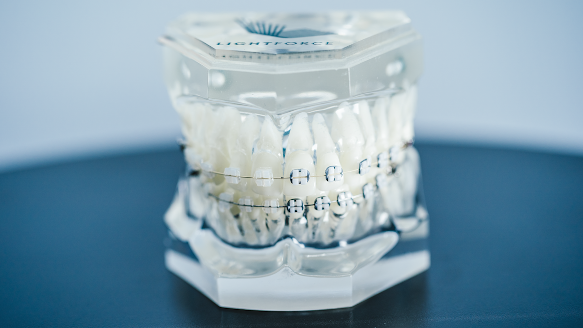 How 3D-Printed Braces Will Shape the Future of Orthodontics