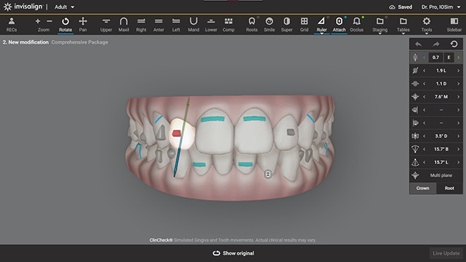 3D Controls | Invisalign Provider