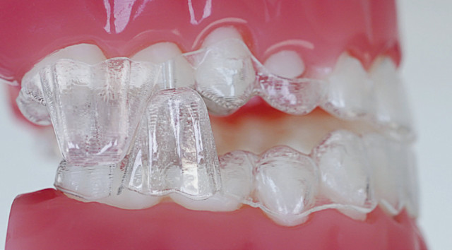 Mandibular Advancement - Orthodontie | Invisalign
