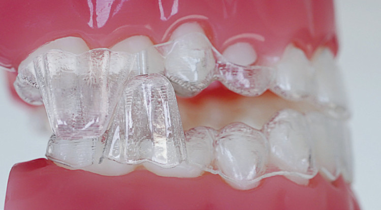 Mandibular Advancement - Orthodontie | Invisalign
