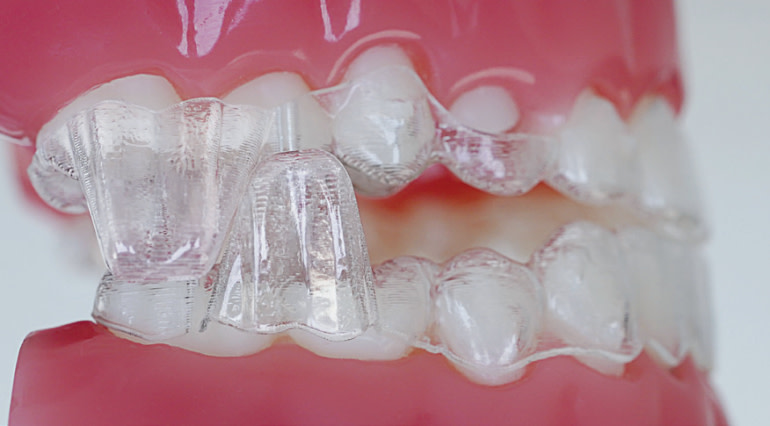 Protrusion: Kieferorthopädie | Invisalign-Anwender