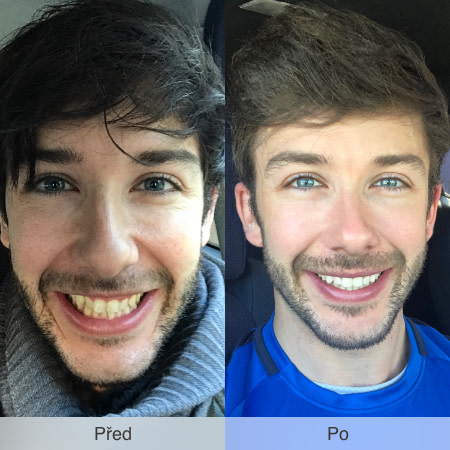 Léčba s Invisalign | Průhledné alignery Invisalign