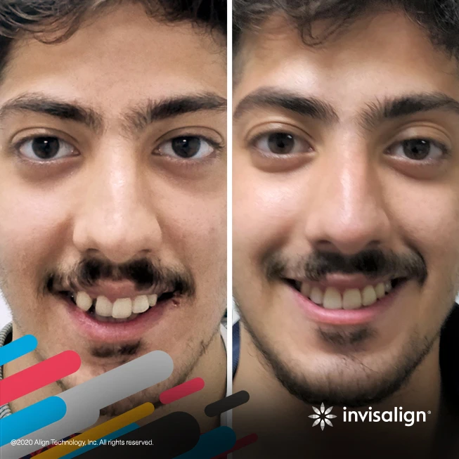 Imagine what Invisalign treatment can do for your smile
