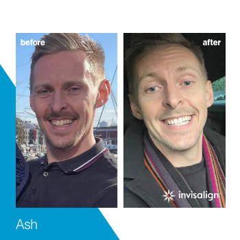 Invisalign Before and After | Success Stories | Invisalign