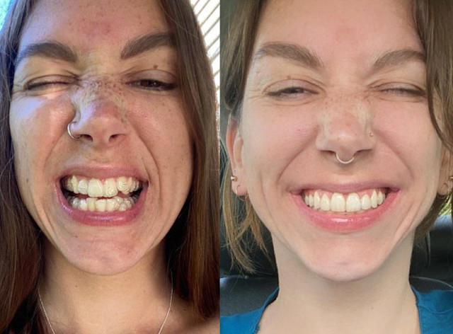 Invisalign Before and After | Success Stories | Invisalign