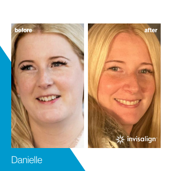 How much is Invisalign treatment? | Invisalign