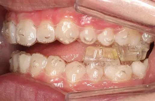 Presentamos el sistema Invisalign® con Avance Mandibular y bloques ...
