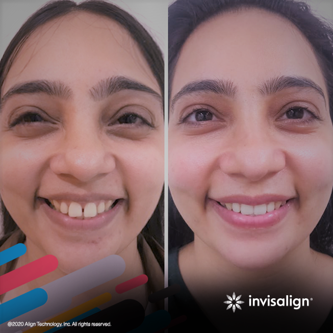 Why Invisalign?