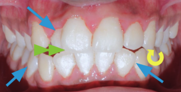 Average Cost of Invisalign® Aligners | Invisalign.com