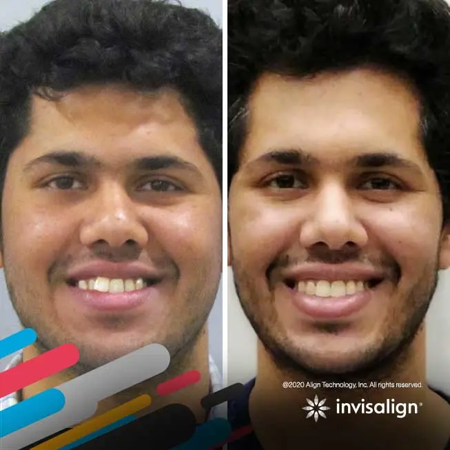 Imagine what Invisalign treatment can do for your smile