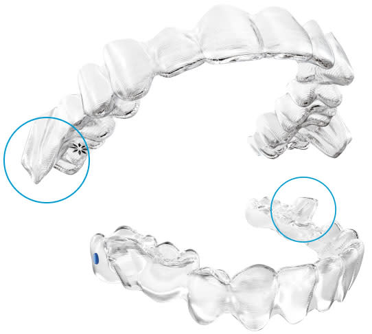Overbite | Invisalign