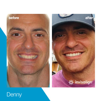 Invisalign treatment | Invisalign clear aligners