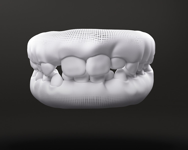 Invisalign First | Invisalign Provider