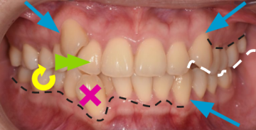 Average Cost of Invisalign® Aligners | Invisalign.com