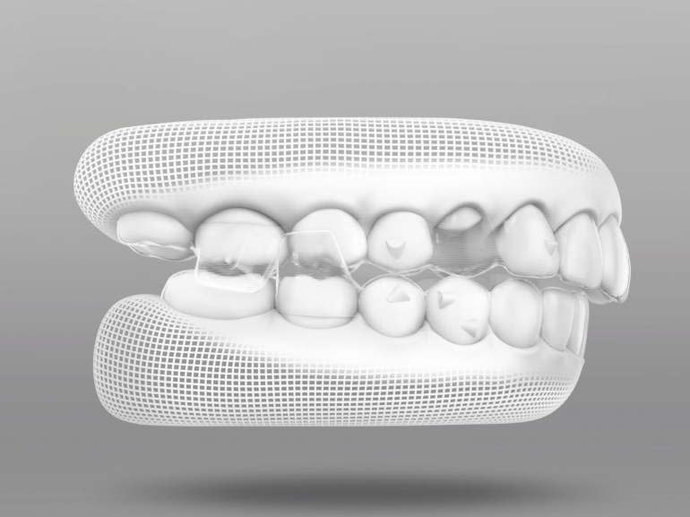 Tipos de pacientes Invisalign – Paciente en edad de crecimiento ...