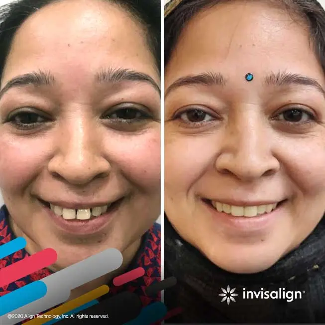 Imagine what Invisalign treatment can do for your smile