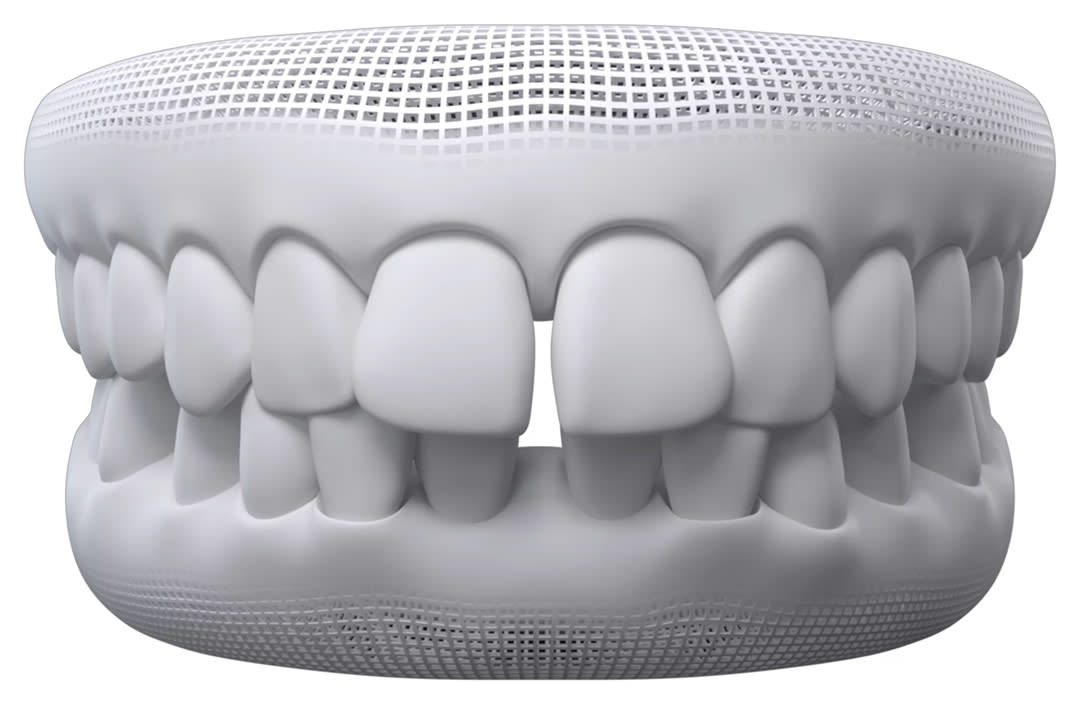 Gap teeth explained: causes & treatment | Invisalign