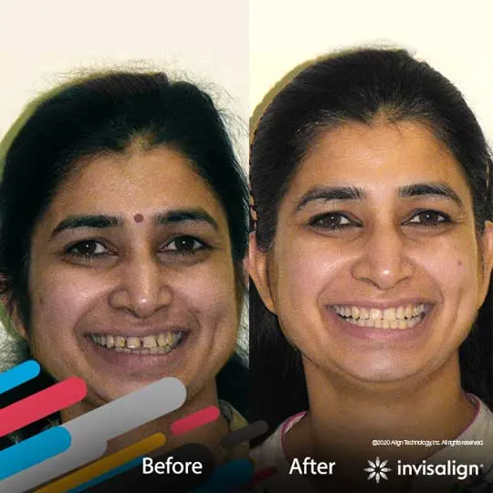Why Invisalign?