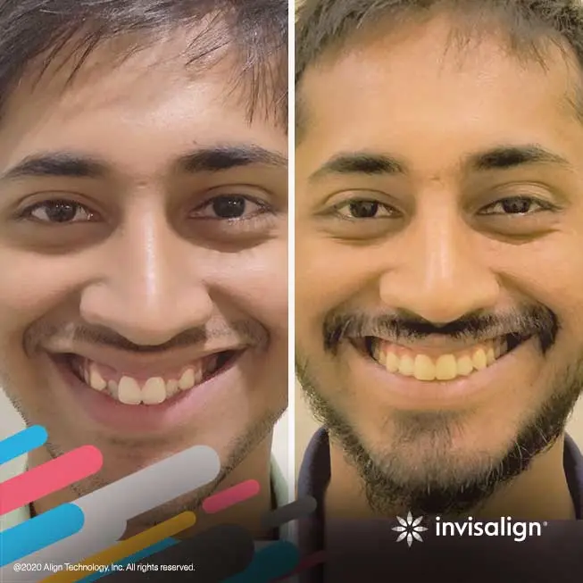 Why Invisalign?