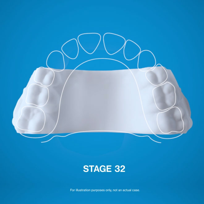 Removable Palatal Expander