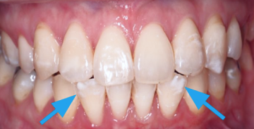 Average Cost of Invisalign® Aligners | Invisalign.com