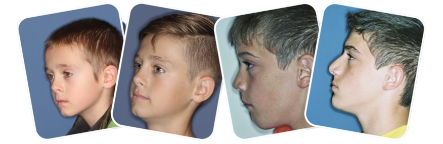 How to Guide Facial Growth in Kids (Full Biobloc Treatment 8-12 Yr Olds ...