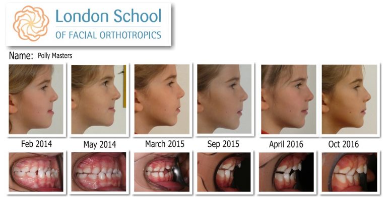 Orthotropics evidence - Orthotropics
