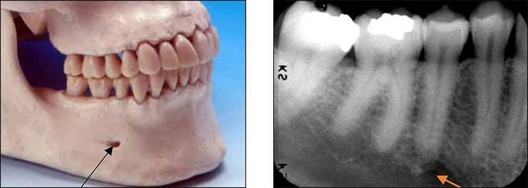Mandibular Posterior Landmarks - Intraoral Radiographic Anatomy ...